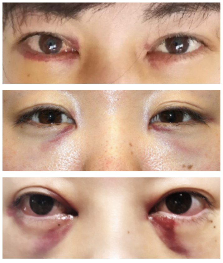 Thyroid Eye Disease | Oculofacial Clinic TOKYO