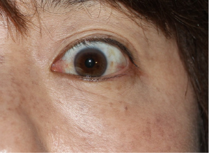 Thyroid Eye Disease | Oculofacial Clinic TOKYO