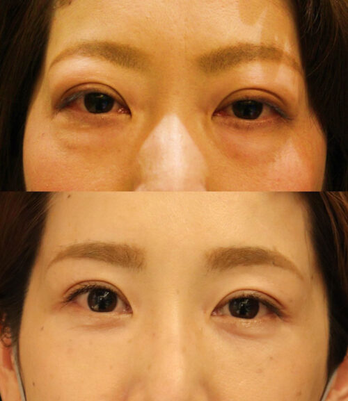 Congenital Bulging Eyes | Oculofacial Clinic TOKYO