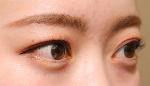 Congenital Bulging Eyes | Oculofacial Clinic TOKYO