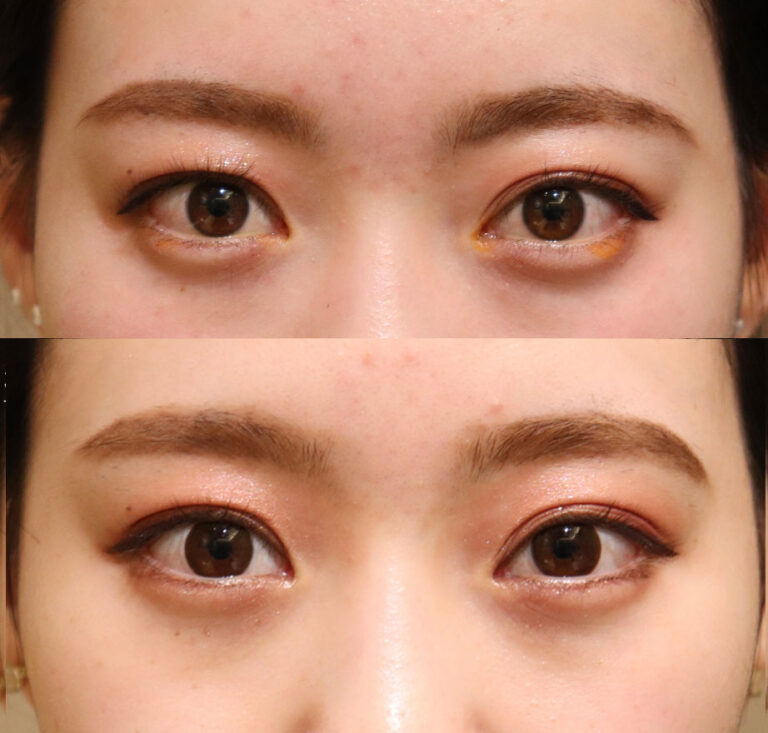 Congenital Bulging Eyes | Oculofacial Clinic TOKYO