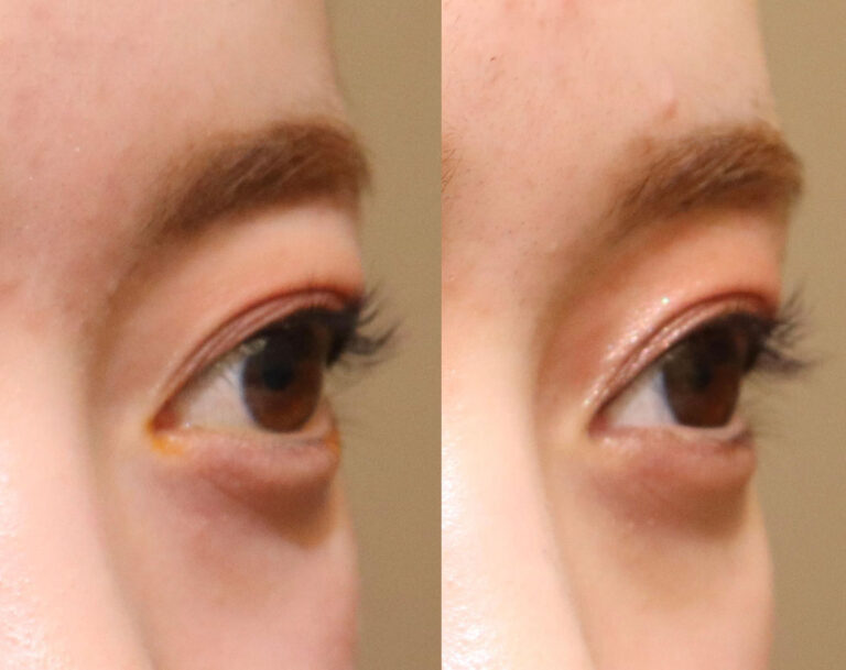 Congenital Bulging Eyes | Oculofacial Clinic TOKYO