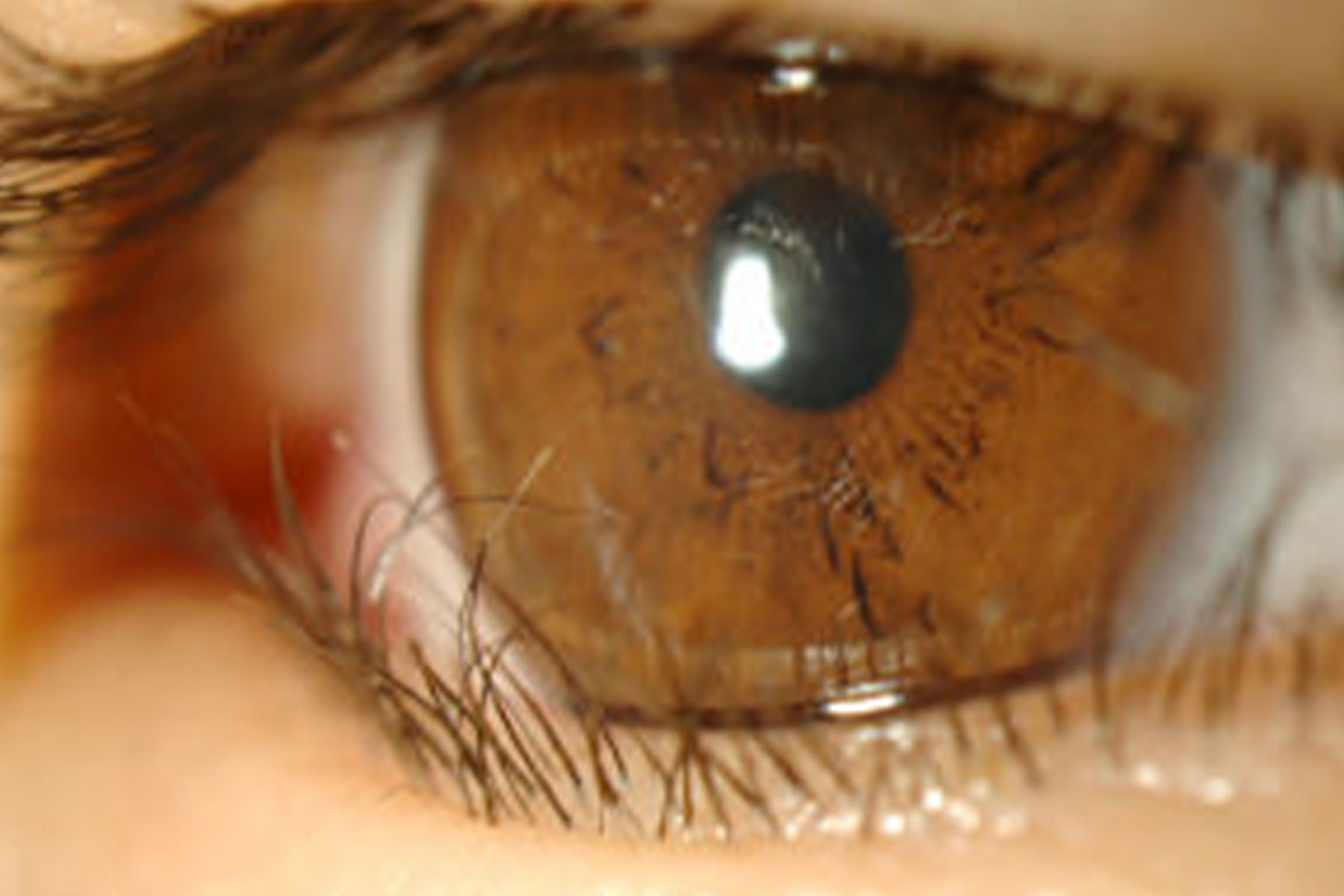 Entropion/Epiblepharon, Mongolian folds｜Oculofacial Clinic TOKYO