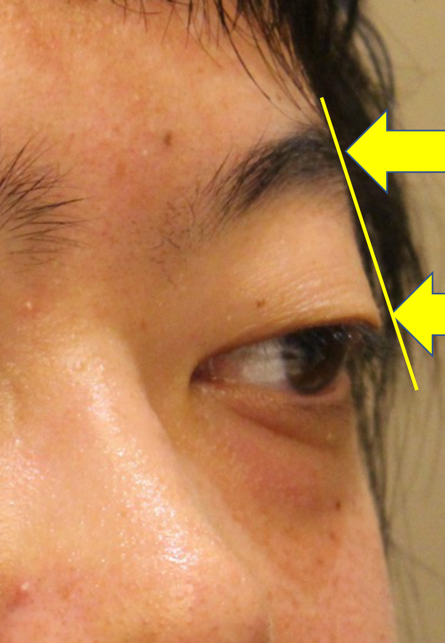 Congenital Bulging Eyes | Oculofacial Clinic TOKYO