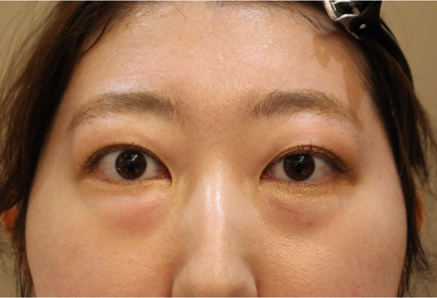 Congenital Bulging Eyes | Oculofacial Clinic TOKYO