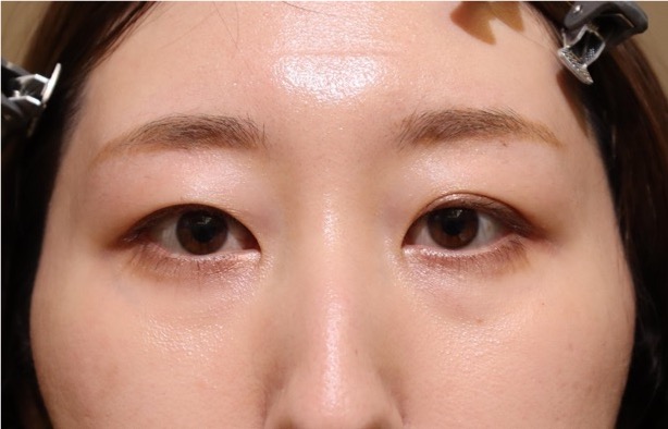 Congenital Bulging Eyes | Oculofacial Clinic TOKYO