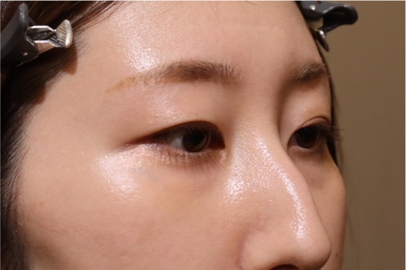 Congenital Bulging Eyes | Oculofacial Clinic TOKYO
