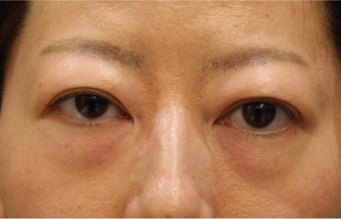 Congenital Bulging Eyes | Oculofacial Clinic TOKYO