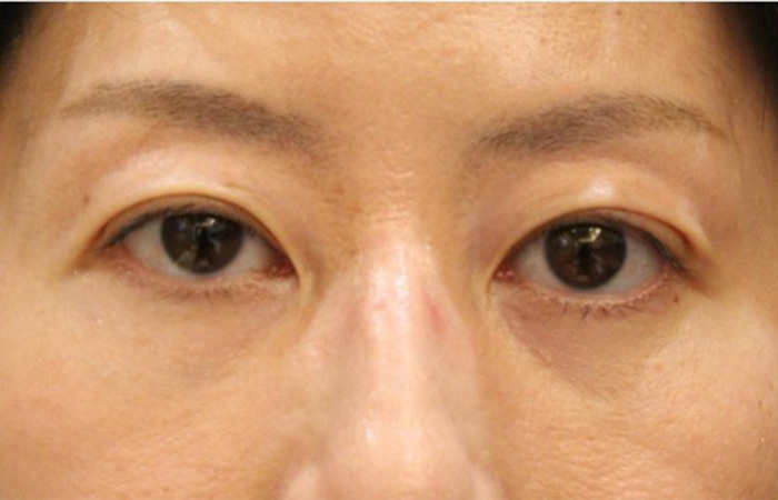 Congenital Bulging Eyes | Oculofacial Clinic TOKYO