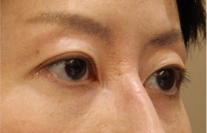 Congenital Bulging Eyes | Oculofacial Clinic TOKYO