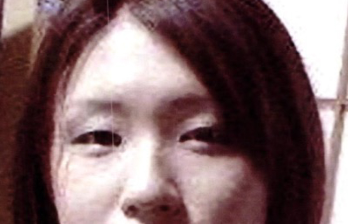 Congenital Bulging Eyes | Oculofacial Clinic TOKYO