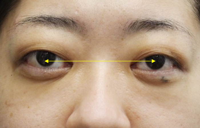Congenital Bulging Eyes | Oculofacial Clinic TOKYO