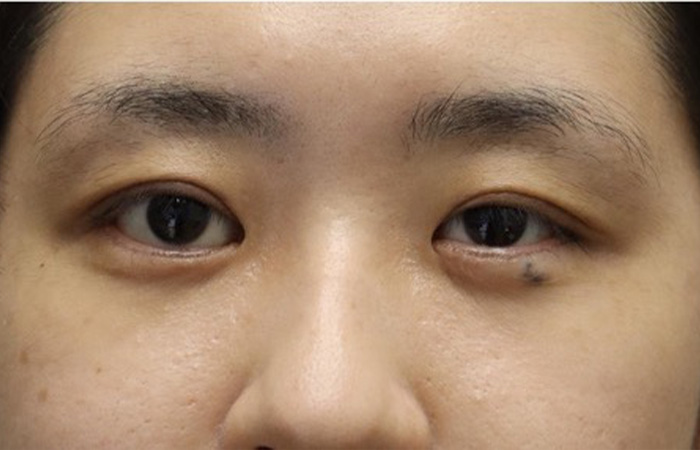 Congenital Bulging Eyes | Oculofacial Clinic TOKYO