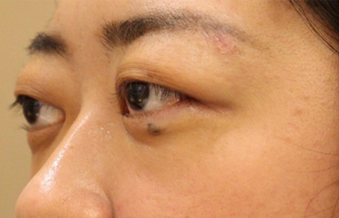 Congenital Bulging Eyes | Oculofacial Clinic TOKYO