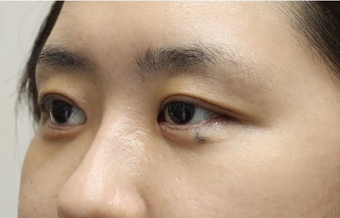 Congenital Bulging Eyes | Oculofacial Clinic TOKYO