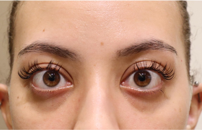 Congenital Bulging Eyes | Oculofacial Clinic TOKYO