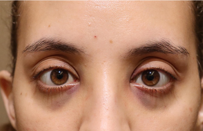 Congenital Bulging Eyes | Oculofacial Clinic TOKYO