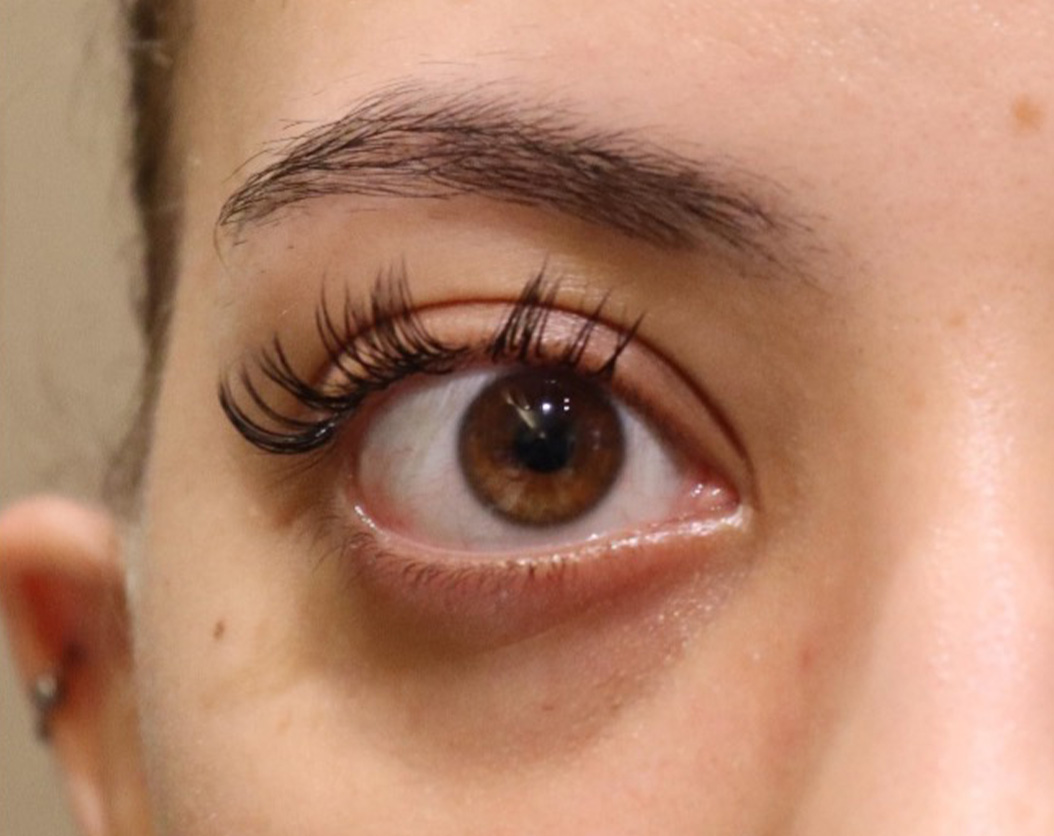 Congenital Bulging Eyes | Oculofacial Clinic TOKYO