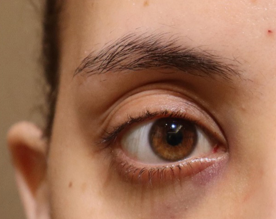 Cosmetic Orbital Surgery | Oculofacial Clinic TOKYO