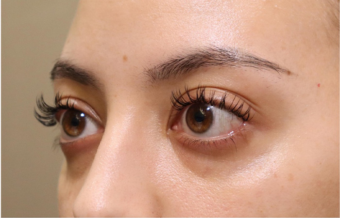 Congenital Bulging Eyes | Oculofacial Clinic TOKYO